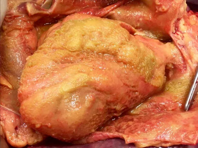 fibrinous pericarditis