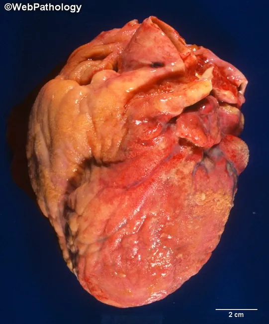 suppurative pericarditis
