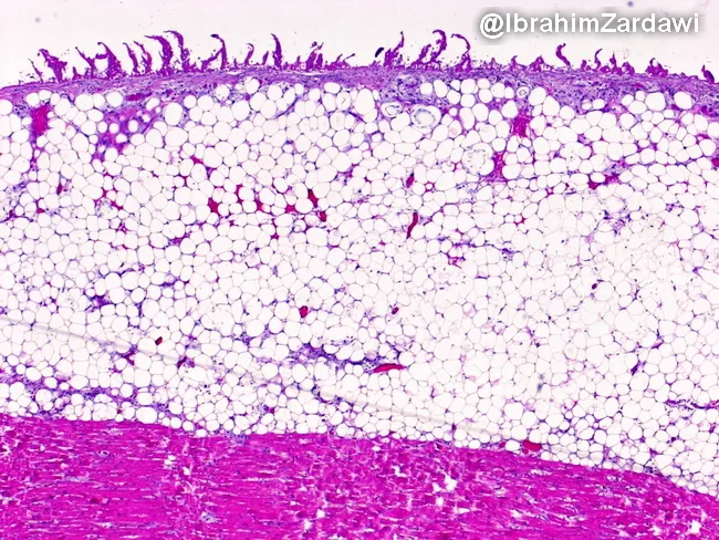 fibrinous pericarditis microscopic
