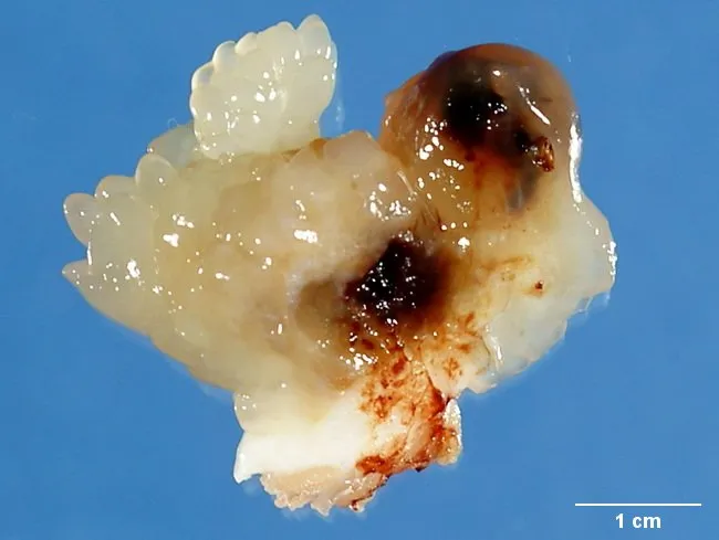 Cardiac Myxoma : Gross Pathology
