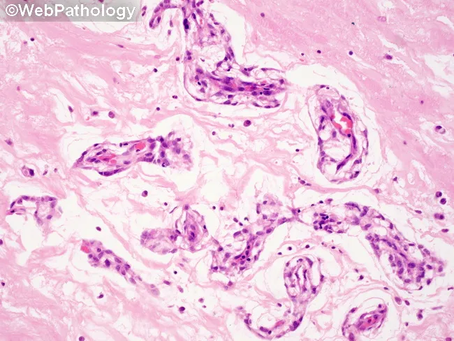 Cardiac Myxoma : Microscopic Features