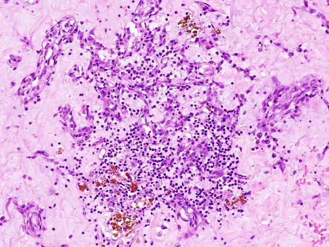 Cardiac Myxoma : Microscopic Features