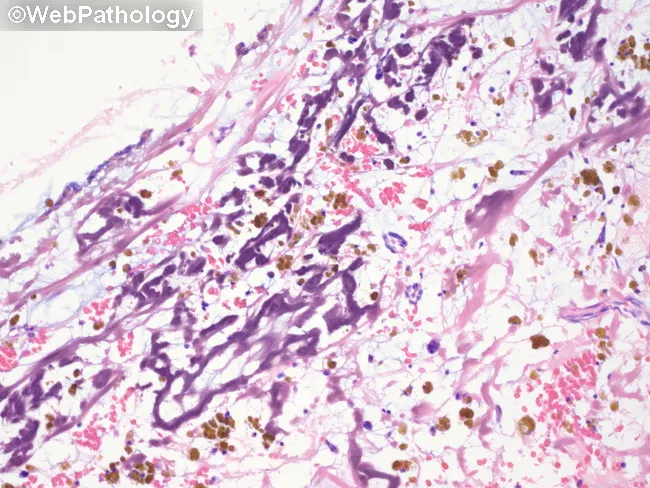 Cardiac Myxoma : Gamna Gandy Bodies