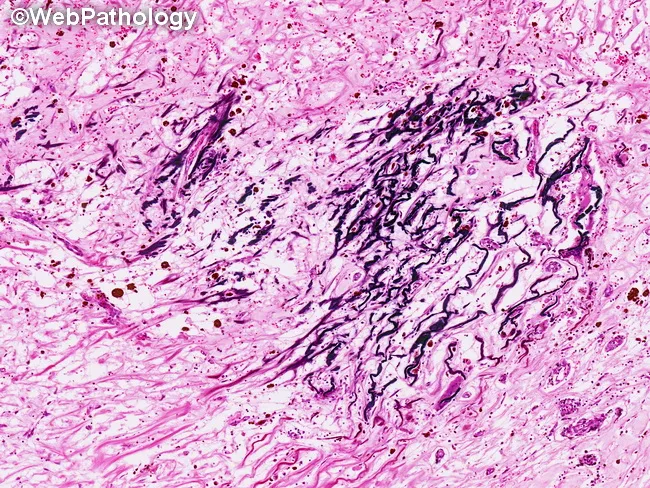 Cardiac Myxoma : Gamna Gandy Bodies