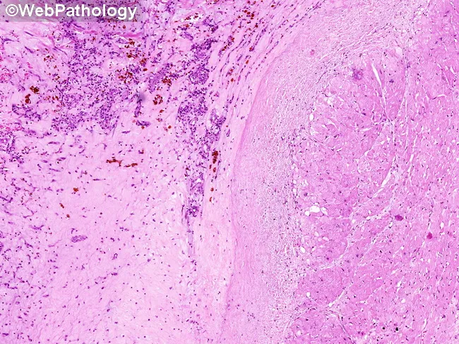 Cardiac Myxoma : Microscopic Features