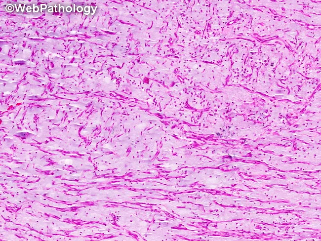 Cardiac Myxoma : Microscopic Features