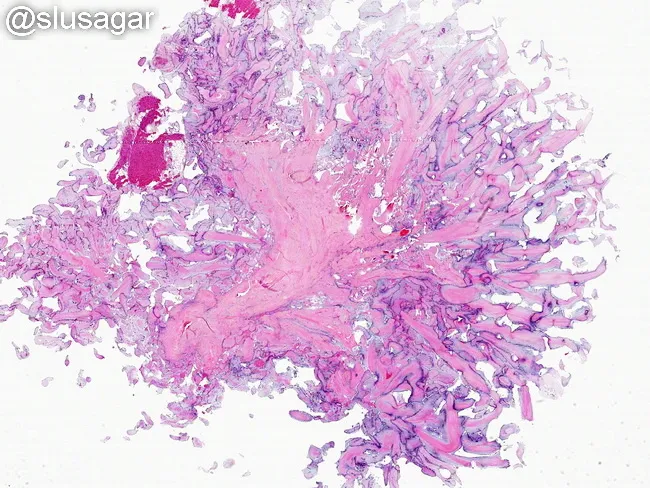 Papillary Fibroelastoma