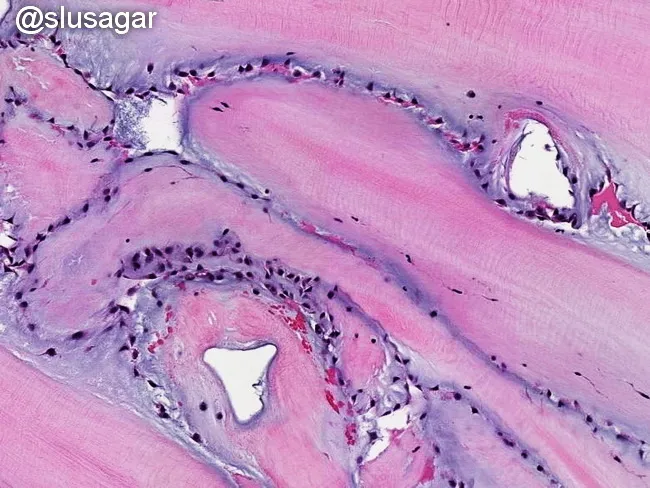 Papillary Fibroelastoma
