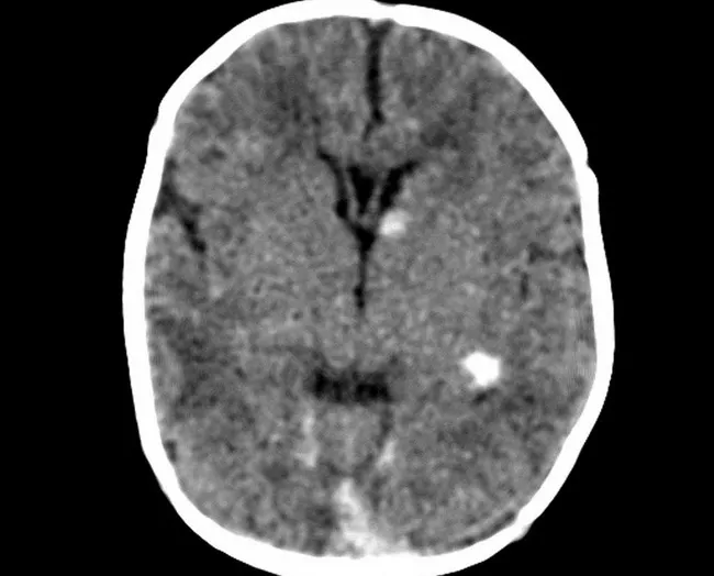 Cardiac Rhabdomyoma & Tuberous Sclerosis