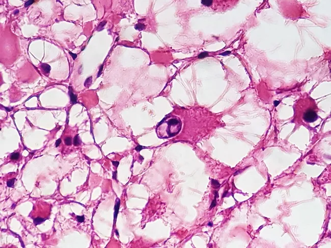 Cardiac Rhabdomyoma : Histology