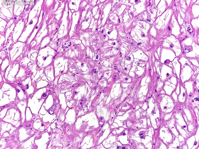 Cardiac Rhabdomyoma : Histology