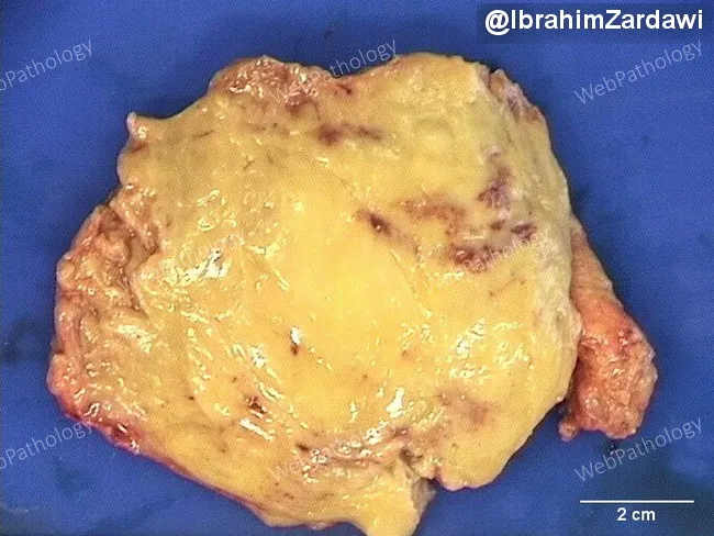 Cardiac Lipoma : Pathology