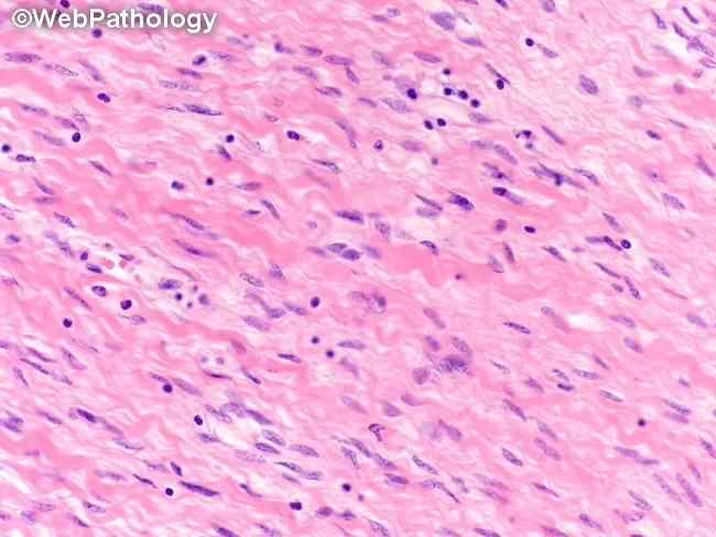 Cardiac Fibroma : Microscopic Features
