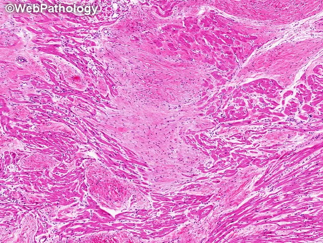 Cardiac Fibroma : Differential Diagnosis