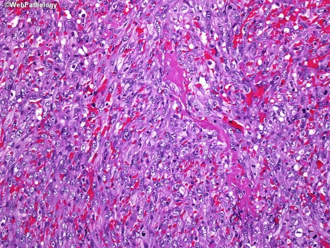 Angiosarcoma of Heart