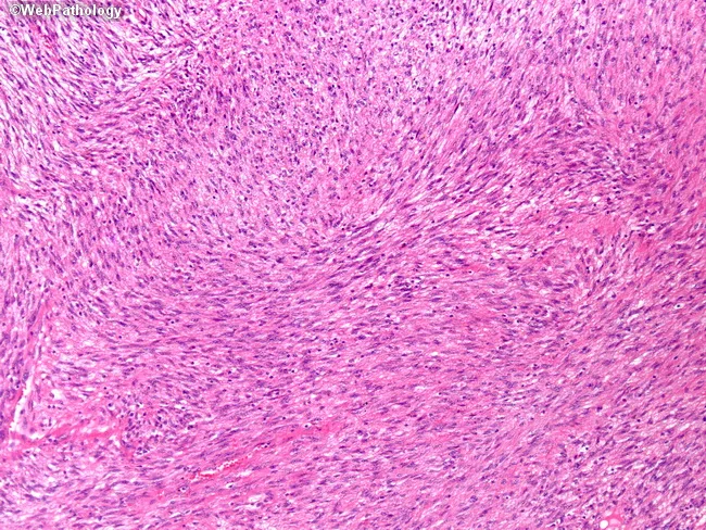Fibrosarcoma of Heart