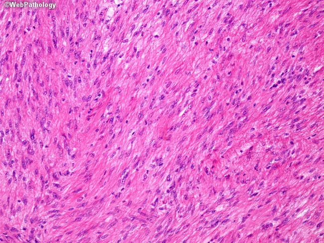 Fibrosarcoma of Heart