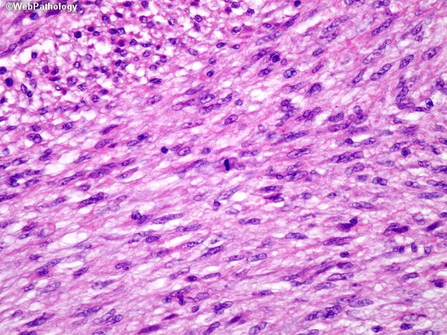 Fibrosarcoma of Heart