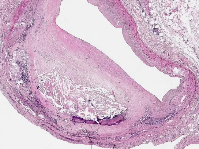 Coronary Atherosclerosis : Stable Plaque