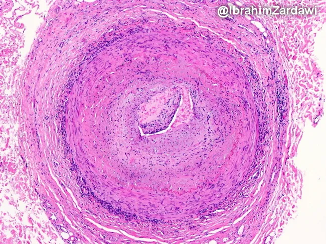 Giant Cell Arteritis : Introduction