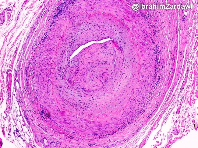 giant cell arteritis
