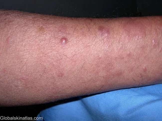 Leprosy : Clinical Presentation