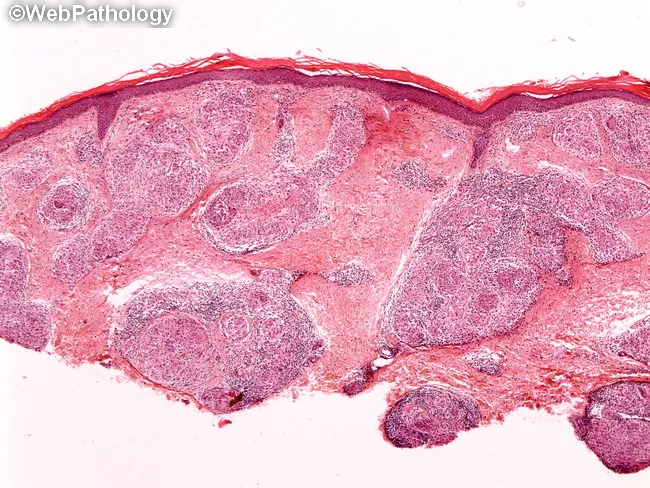papulonecrotic tuberculid histopath