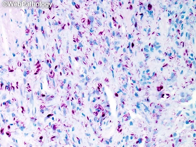 Mycobacterium Leprae : Wade-Fite Stain