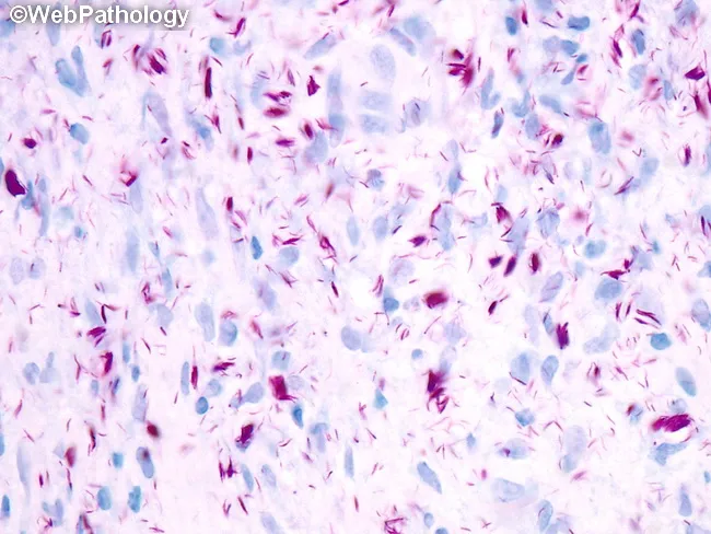 Mycobacterium Leprae : Wade-Fite Stain