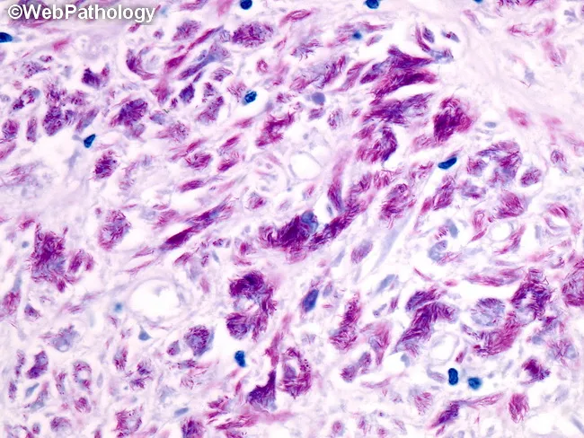 Mycobacterium Leprae : Wade-Fite Stain