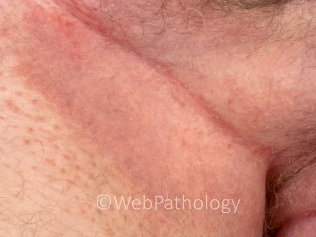 candida intertrigo cks