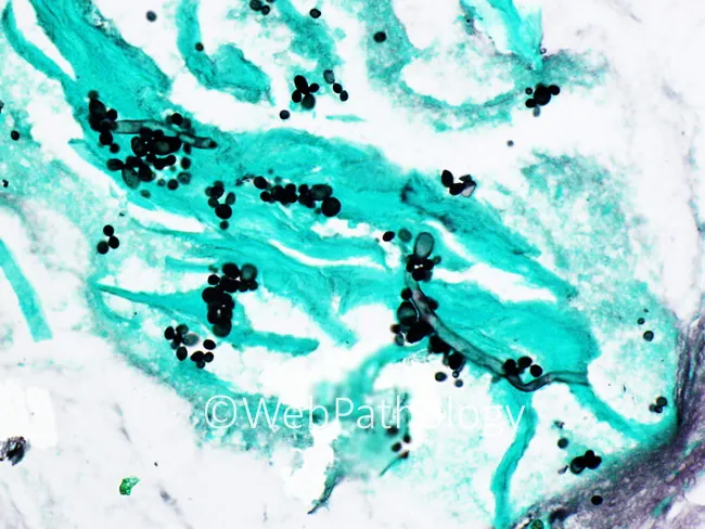 Candidiasis : Lungs