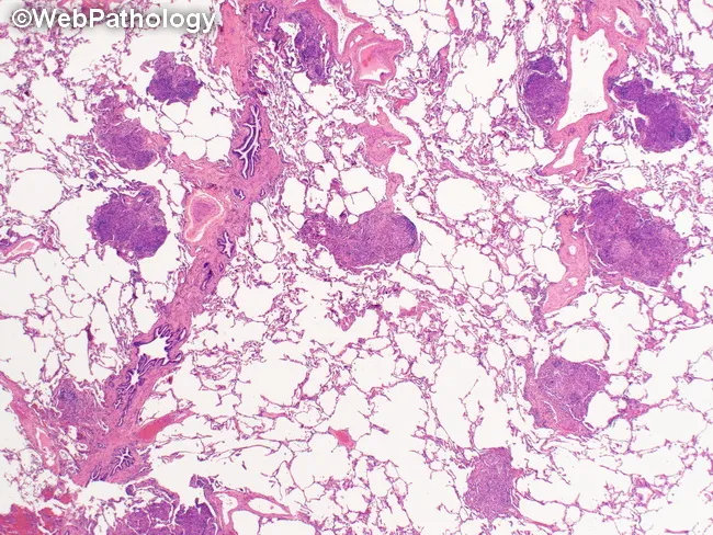 Pulmonary Coccidioidomycosis: Pathology