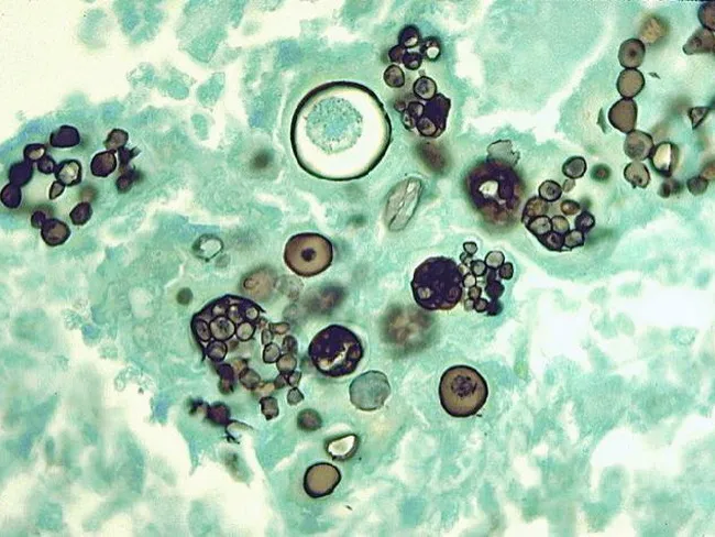 Coccidioidomycosis : Diagnosis