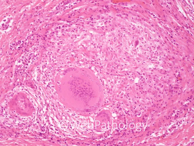 Cutaneous Coccidioidomycosis