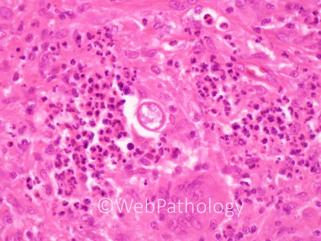 Cutaneous Coccidioidomycosis