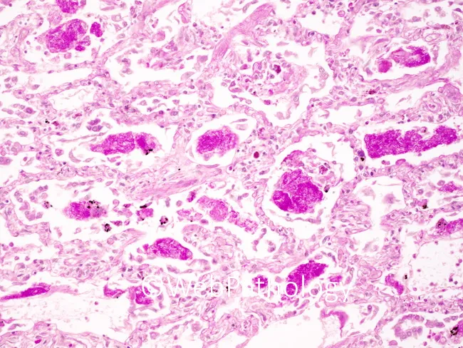 Pneumocystis Pneumonia : Clinical Features
