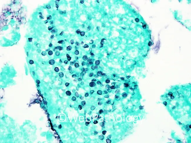 Pneumocystis Pneumonia : GMS Stain
