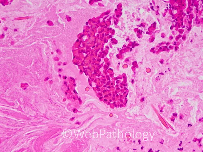 Allergic Fungal Sinusitis : Pathology