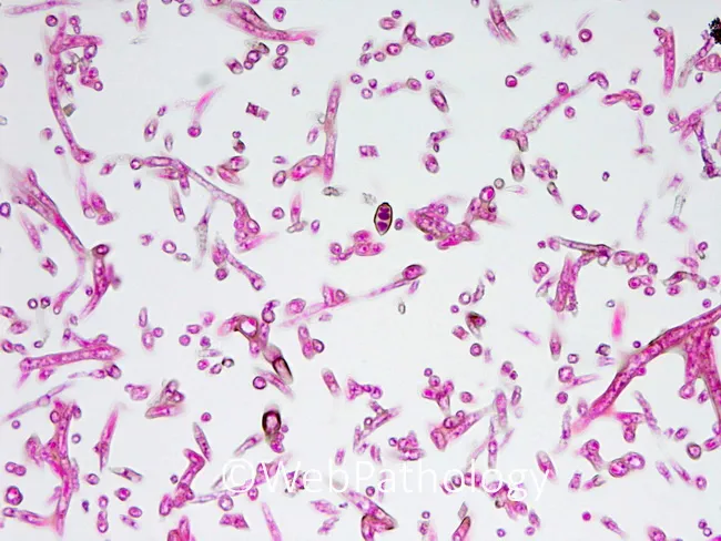 Bipolaris : Fungal Culture Cell Block
