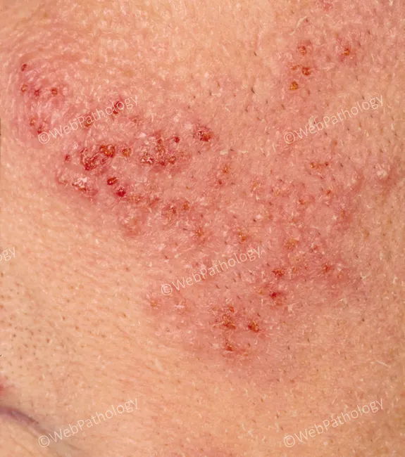 Facial Herpes