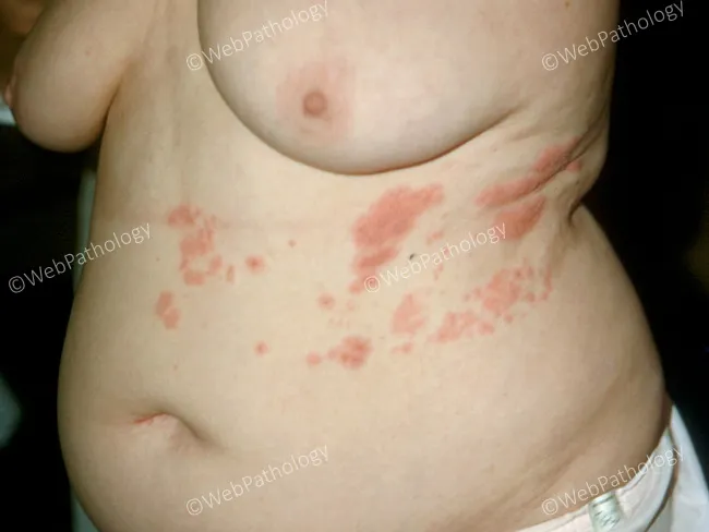 herpes simplex nipple