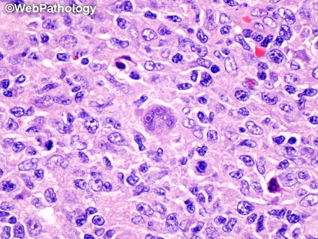 Infectious Mononucleosis - Tonsils
