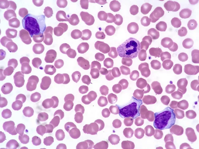 Infectious Mononucleosis - Peripheral Blood