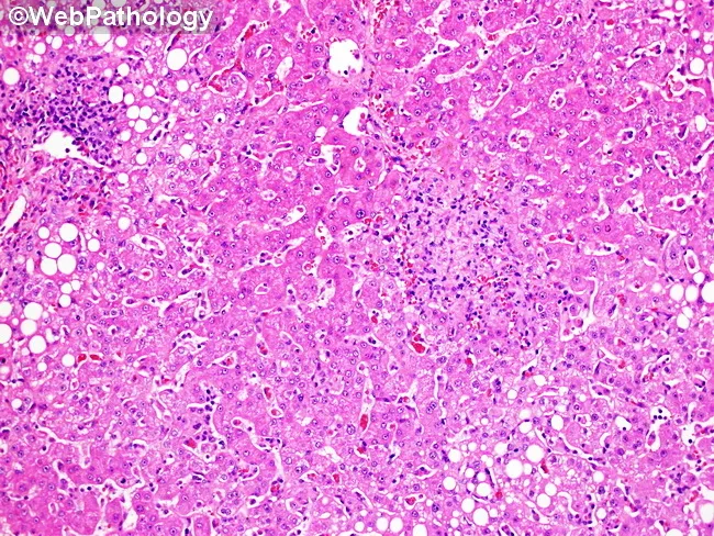 Epstein-Barr Virus Hepatitis
