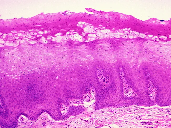 Oral Hairy Leukoplakia