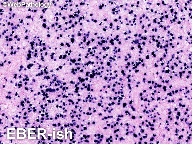 EBV+ DLBCL : EBER