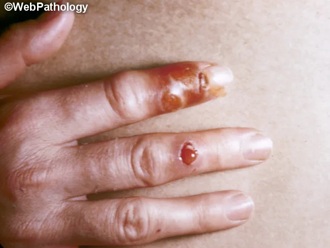 Ecthyma Contagiosum (Orf)