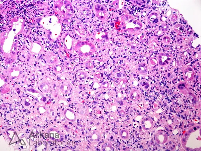 BK/Polyomavirus Nephritis