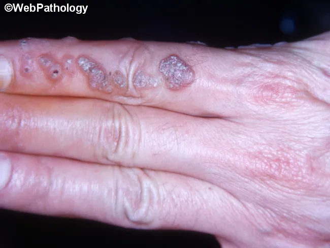 HPV Transmission